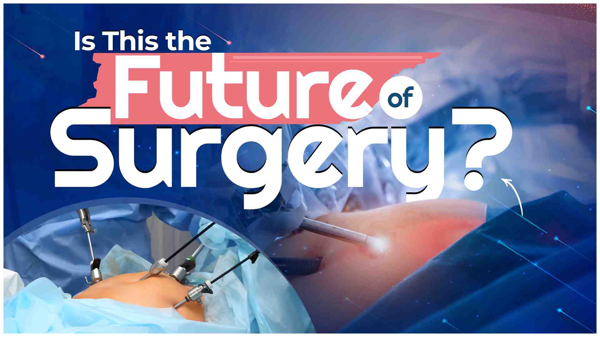 The Future of Surgery: Why Laparoscopic Surgery proved to be a Game ...